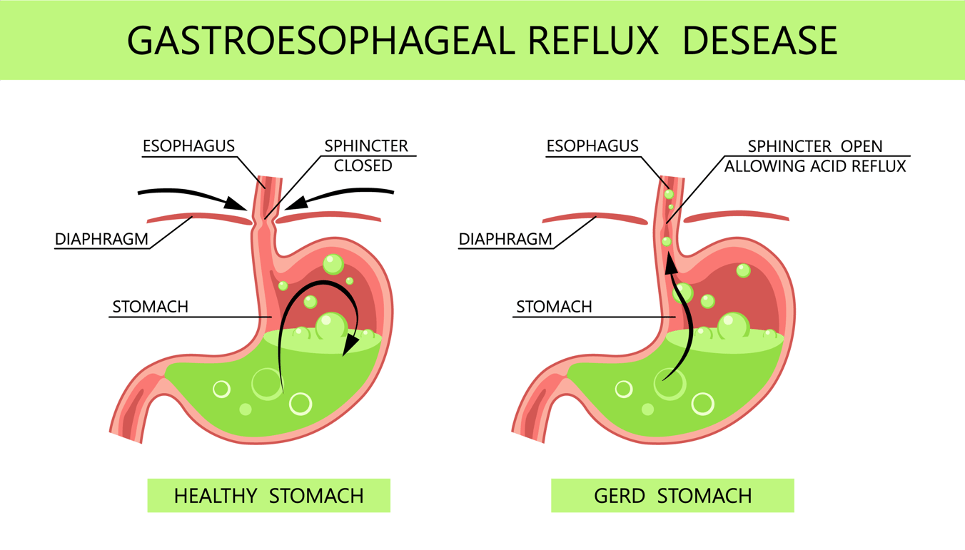 GERD (Gastroesophageal Reflux Disease) | DRHC Gastroenterology Dubai